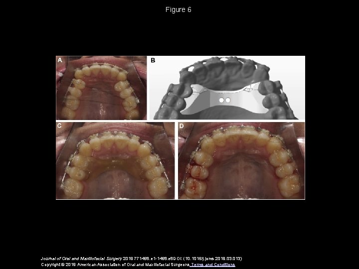 Maintenance of Segmental Maxillary Expansion The Use of