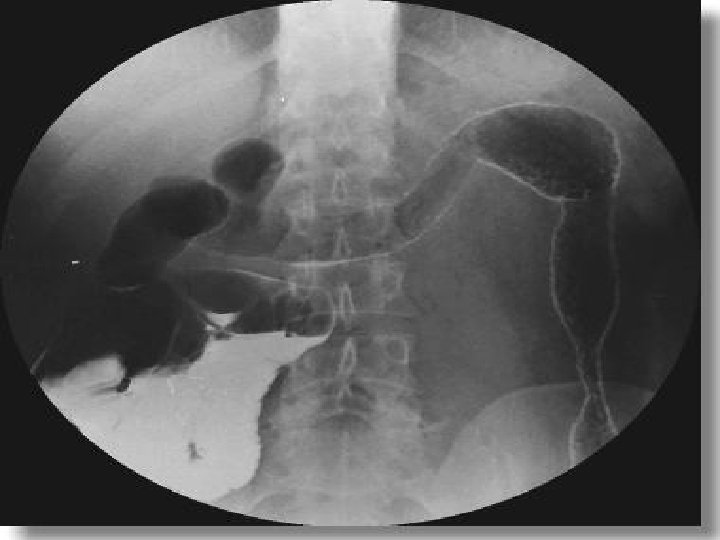 Midterm Barium Enema Large Intestine It begins in
