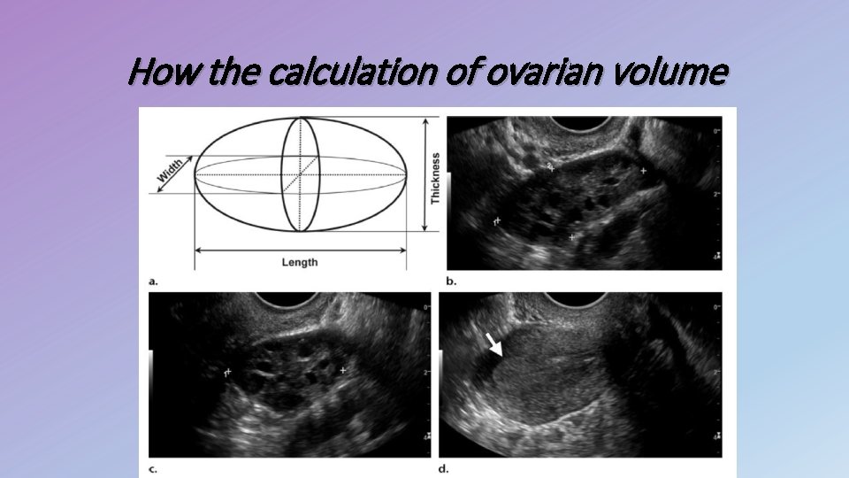 Polycystic Ovarian Syndrome Role of Imaging in Diagnosis