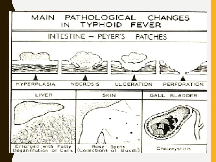 11216 INFECTIVE ULCERS OF THE INTESTINE DR A