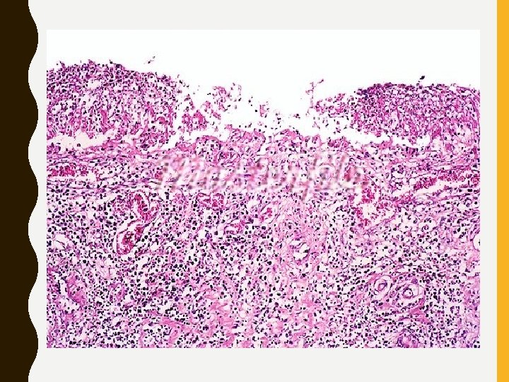 11216 INFECTIVE ULCERS OF THE INTESTINE DR A