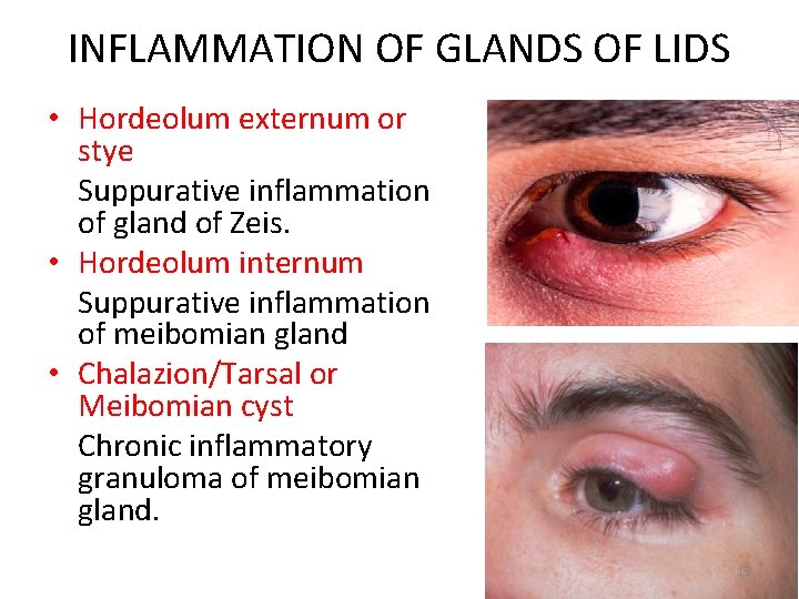 Disorders of Lid Dr Ajai Agrawal Additional Professor