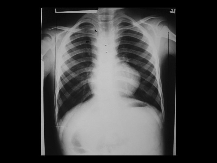 CYANOTIC SPELLS paroxysmal hyperpnea hypoxic spells anoxic spells