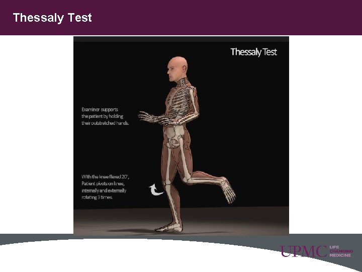 Meniscus Injuries Ian Rice MD How far we