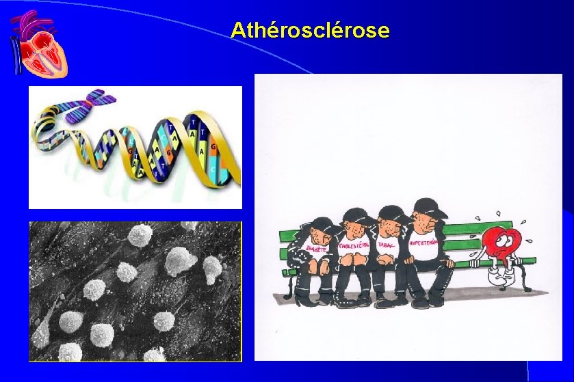 Infarctus du Myocarde ou Syndromes coronaires avec et