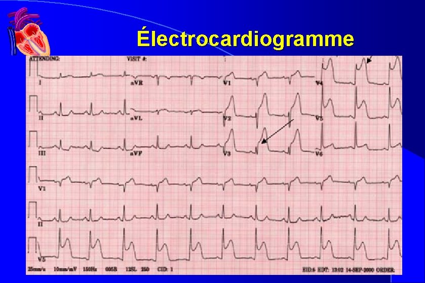 Infarctus du Myocarde ou Syndromes coronaires avec et