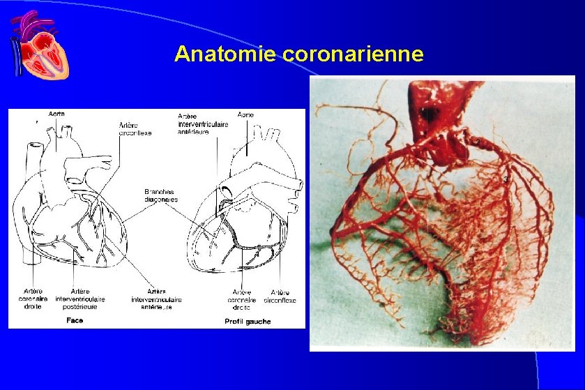 Infarctus du Myocarde ou Syndromes coronaires avec et