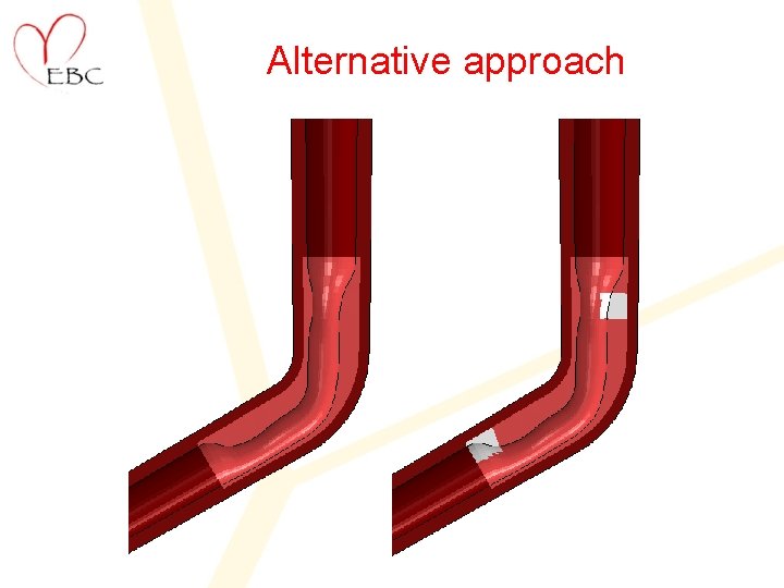 Peter Mortier Bifurcation stenting simulation the vessel IBi