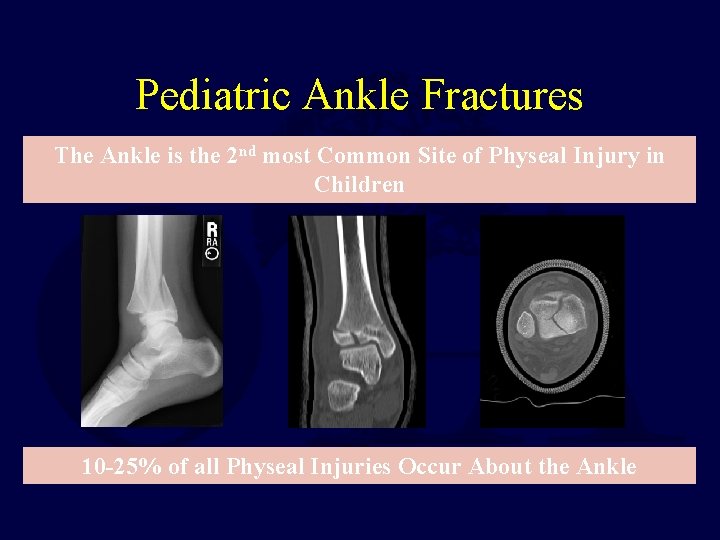 Pediatric Ankle Fractures Anthony I Riccio MD Texas