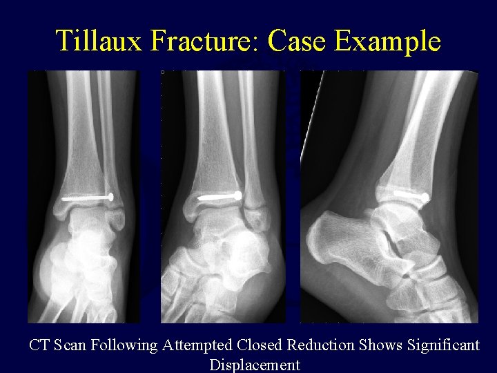Pediatric Ankle Fractures Anthony I Riccio MD Texas