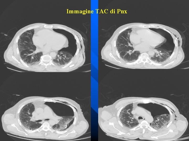 Pneumotorace Pnx Si intende per pnx spontaneo labnorme