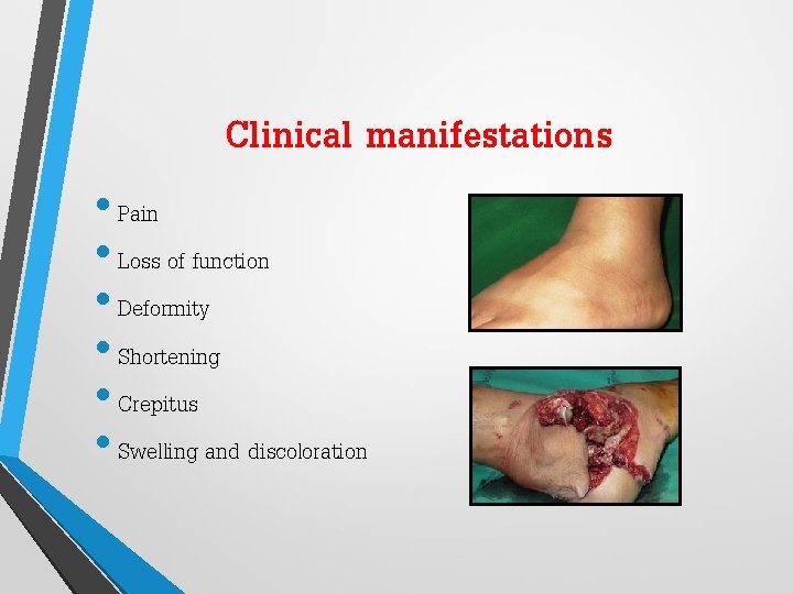 2558 1 Fracture Femur 579 Lower leg include