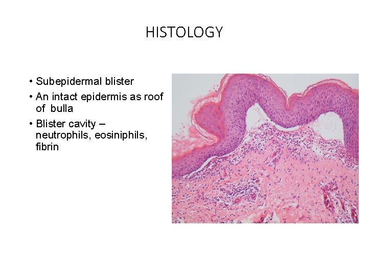 AUTOIMMUNE BULLOUS DISORDERS II Neirita Hazarika BULLOUS PEMPHIGOID