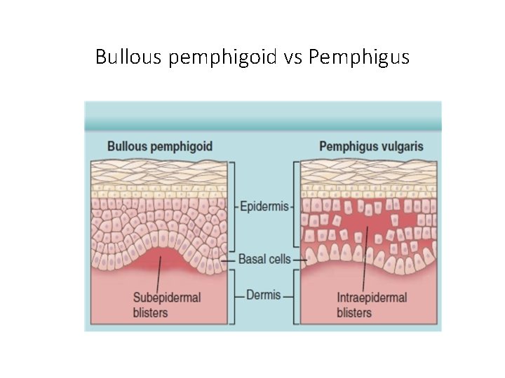 AUTOIMMUNE BULLOUS DISORDERS II Neirita Hazarika BULLOUS PEMPHIGOID