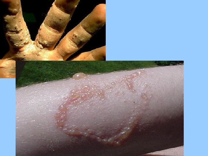 Integumentary System Skin Disorders and Diseases Contact Dermatitis