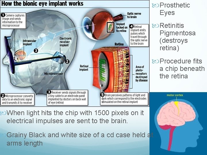 Prosthetics Whats available now Prosthetic arms that use