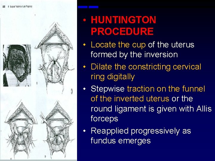 UTERINE INVERSION ANUPAMA TAMRAKAR OBGYN YNC 1 Introduction