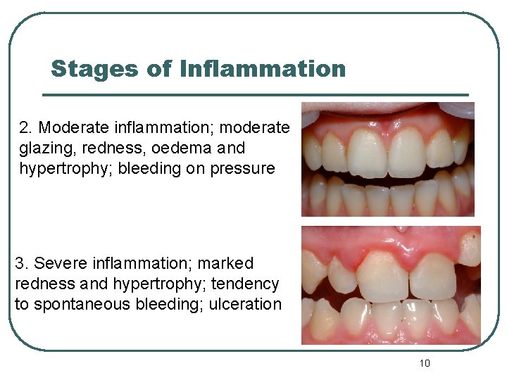 Oral Health Training Calibration Programme Gingival Index 1
