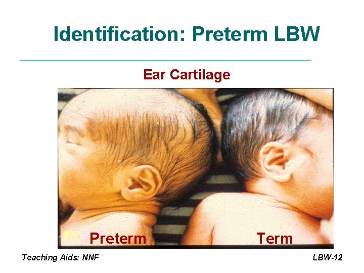Management of Low Birth Weight Babies Teaching Aids