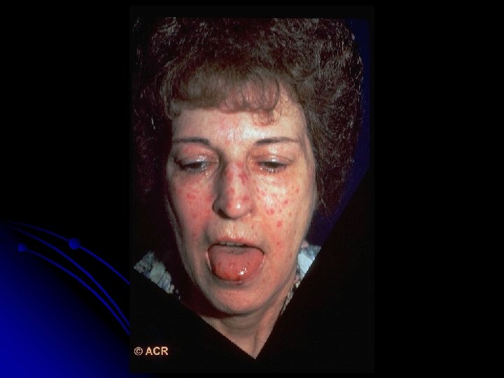 Esclerodermia Esclerodermia Scleros derma endurecimiento piel ...