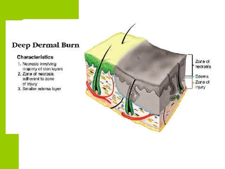 Initial Care of Burns Connie Handel RN University