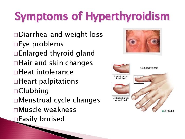 Disorders of the Thyroid By Jessica Stevens Normal