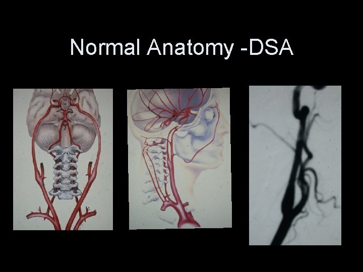 Neuroradiology presents Cerebrovascular Disease David M Pelz MD