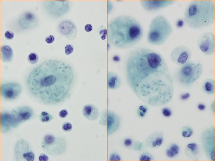Cytologic characteristics Cellularity high Cellular composition ...