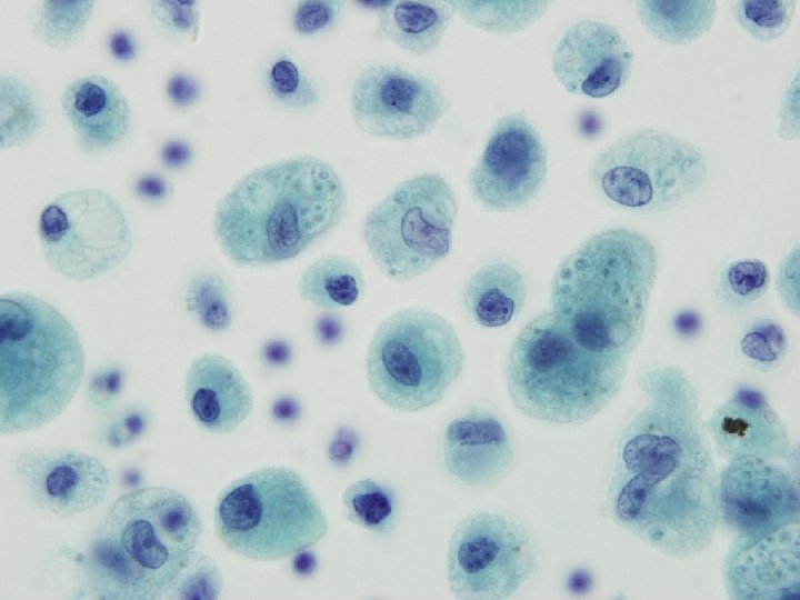 Cytologic characteristics Cellularity high Cellular composition ...