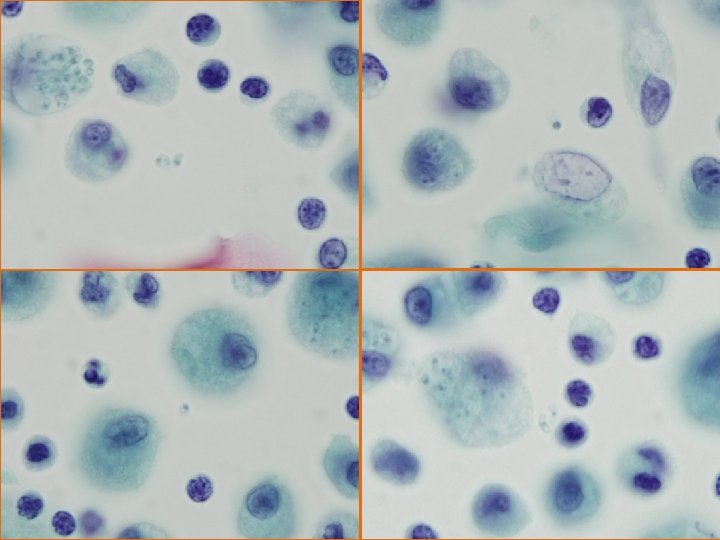 Cytologic characteristics Cellularity high Cellular composition ...