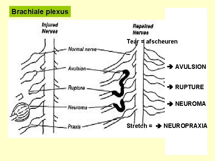 Erbs Palsy Law for victims of Brachial Plexus