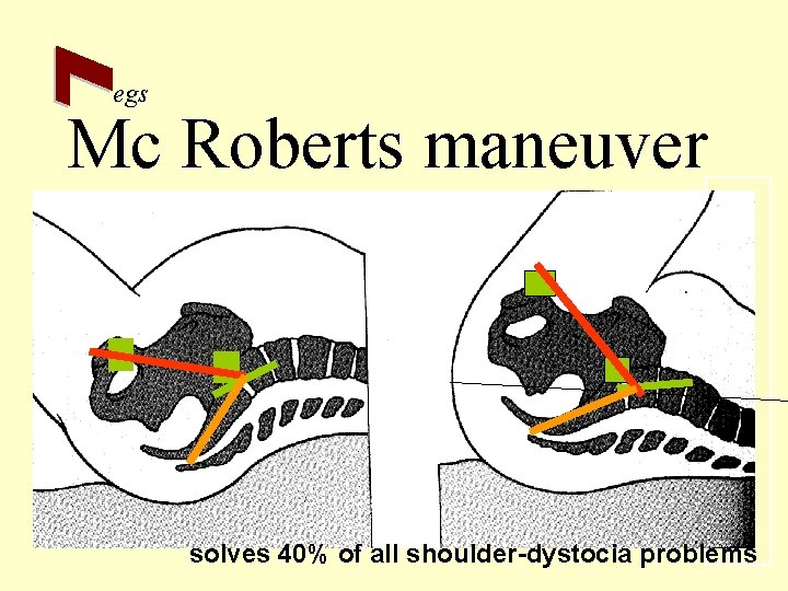 Erbs Palsy Law for victims of Brachial Plexus