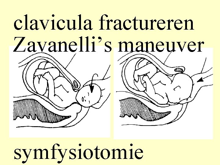 Erbs Palsy Law for victims of Brachial Plexus