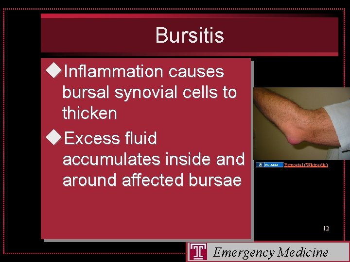 Project Ghana Emergency Medicine Collaborative Document Title Bursitis