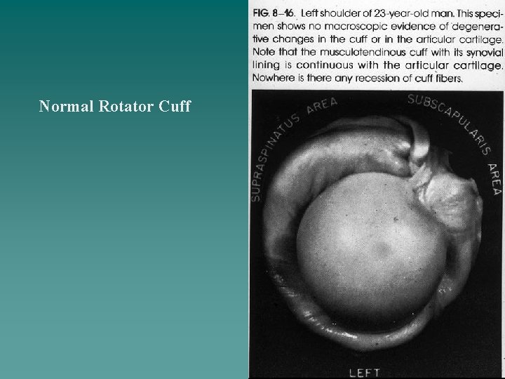 Lecture 2 Axilla Shoulder Brachial Plexus Axilla Anterior