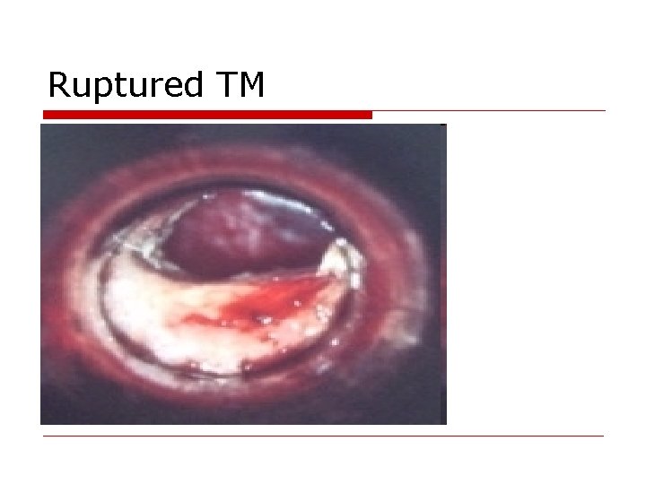 Childhood Otitis Media By Rahul Gladwin MS 3