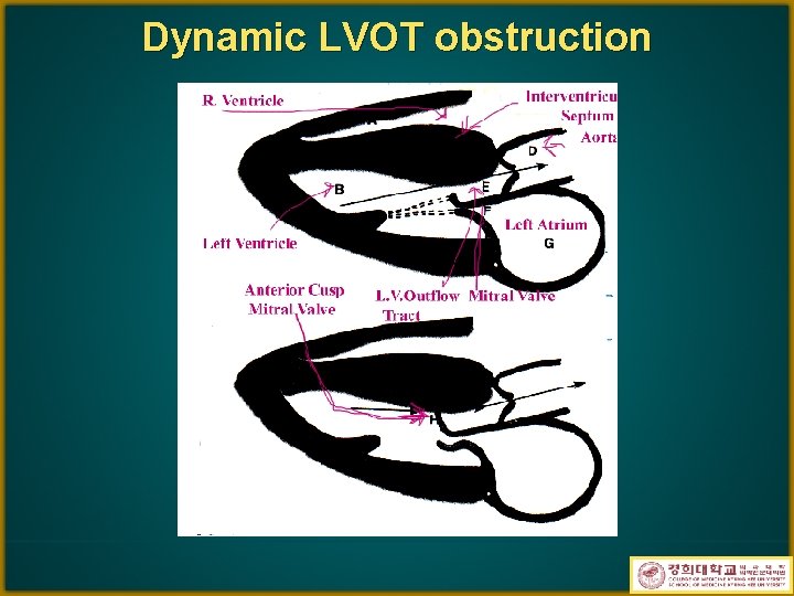 Clinical Classification of Cardiomyopathy Dilated Left andor right