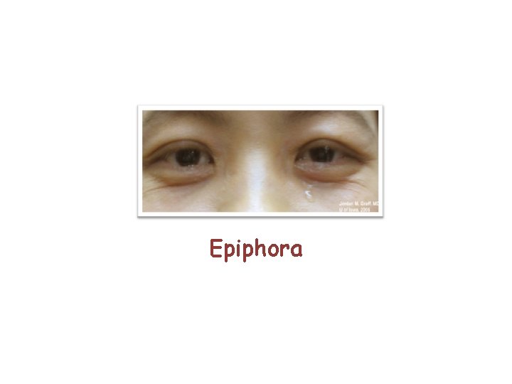 Anatomy and diseases of lacrimal apparatus The lacrimal