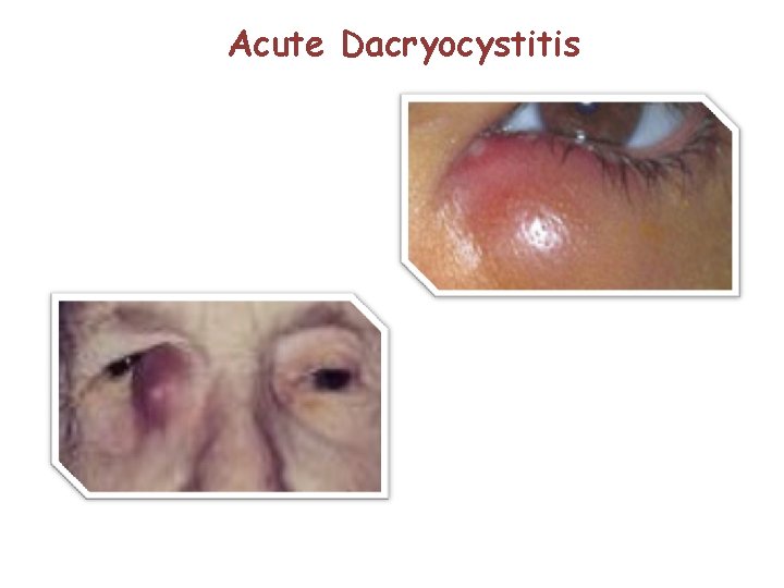 Anatomy and diseases of lacrimal apparatus The lacrimal