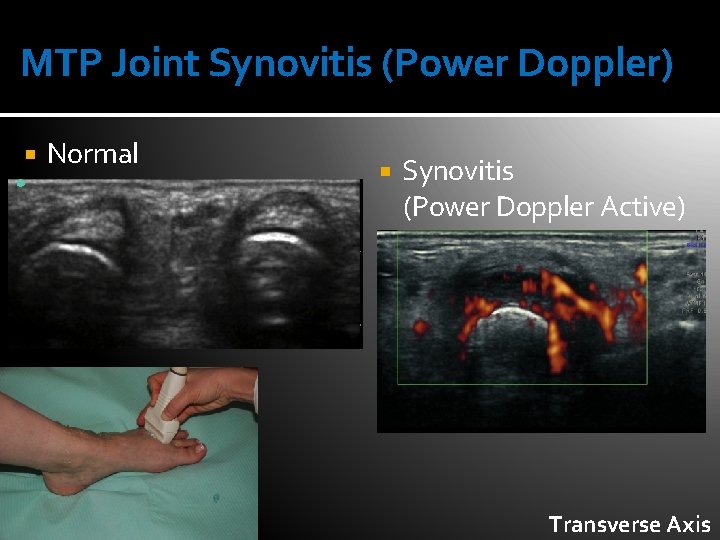 Foot and Ankle Pathology in Rheumatic Diseases Ankle