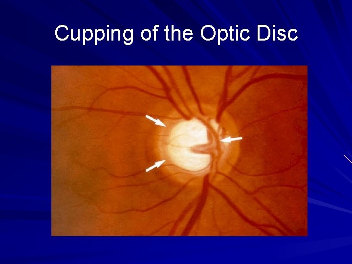 Visual Impairment Awareness A Collaboration between University Hospital