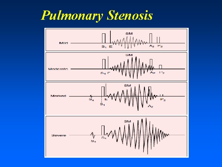 Second Heart Sound Key to Auscultation Dr I
