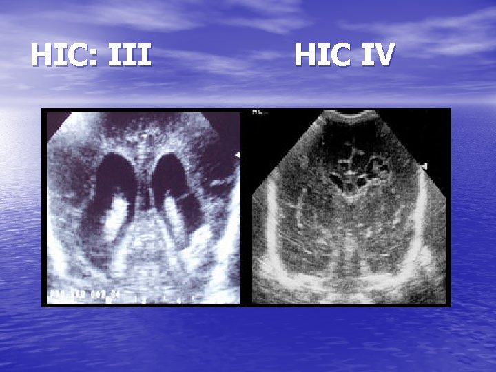 SEGUIMIENTO DEL RECIN NACIDO PREMATURO Un poco de