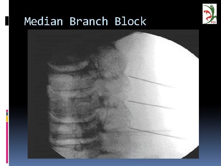 Dr Kailash Kothari MD CERVICAL MEDIAN BRANCH BLOCK