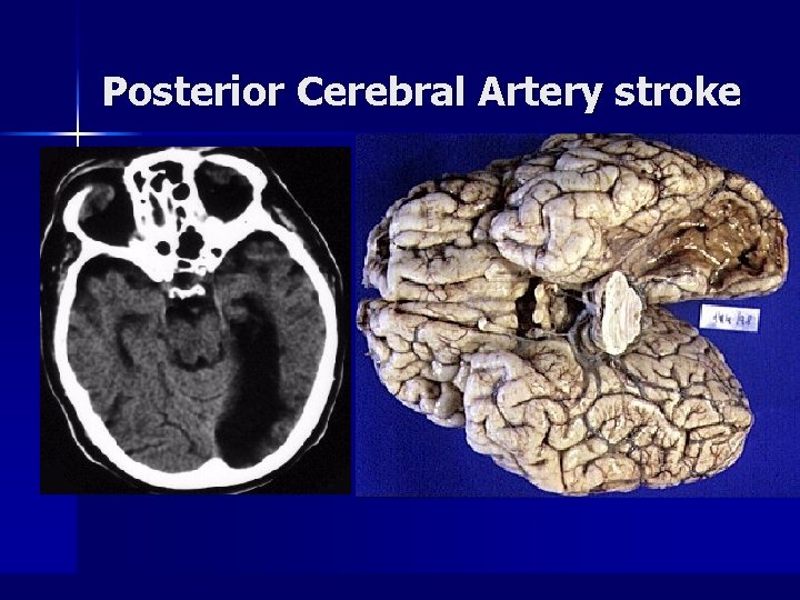 Stroke Stroke n n n Second important cause