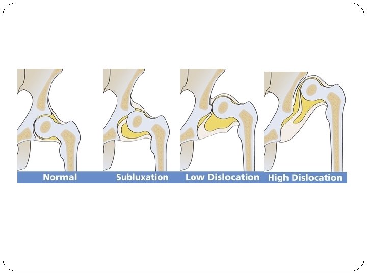 DDH Developmental dysplasia of the hip Saja Aloran