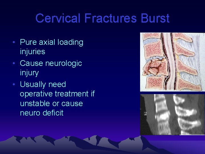 Basic Spine Fractures Naftaly Attias MD Orthopedic Department
