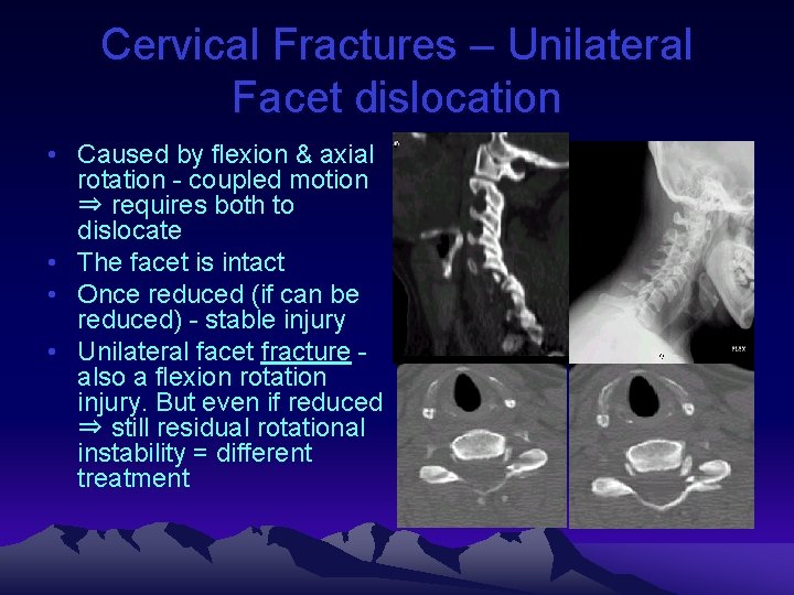 Basic Spine Fractures Naftaly Attias MD Orthopedic Department