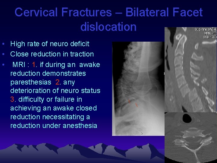 Basic Spine Fractures Naftaly Attias MD Orthopedic Department