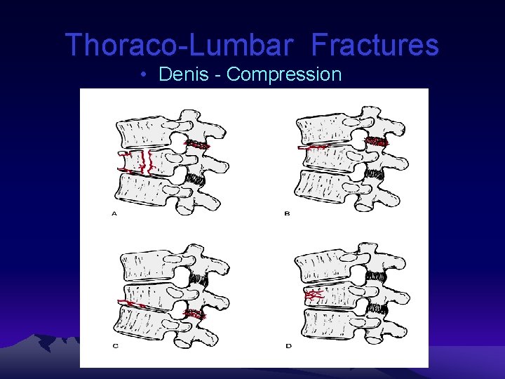 Basic Spine Fractures Naftaly Attias MD Orthopedic Department